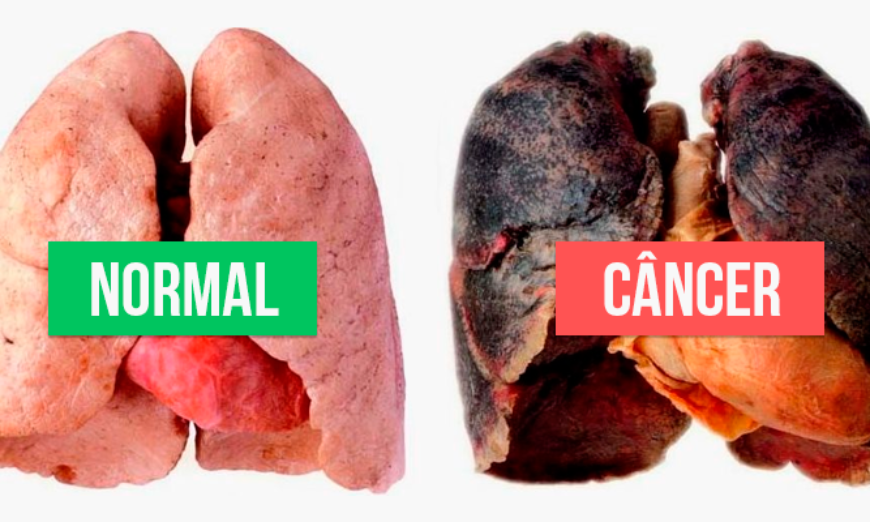 CÂNCER DE PULMÃO, É indicado em indivíduos assintomáticos que apresentem…